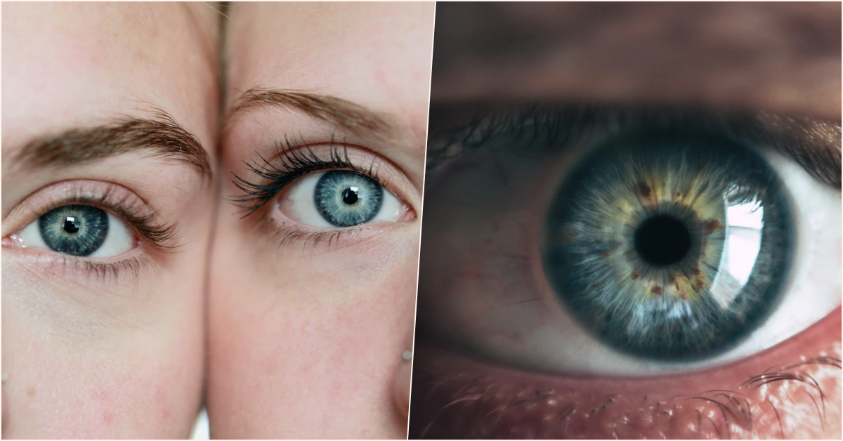 Arpacık Neden Olur, Nasıl Geçer? - Onedio