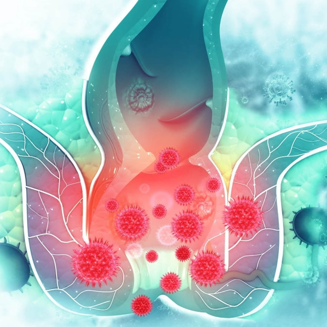 Fistül Nedir? Belirtileri ve Tedavisi… - Onedio