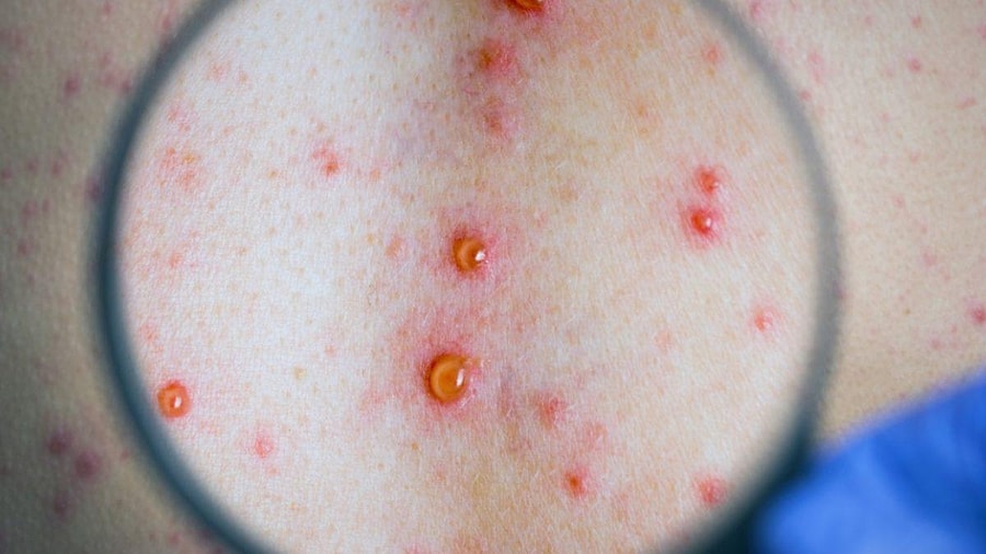 Frengi Nedir? Frengi (Sifiliz) Belirtileri ve Tedavisi… - Onedio