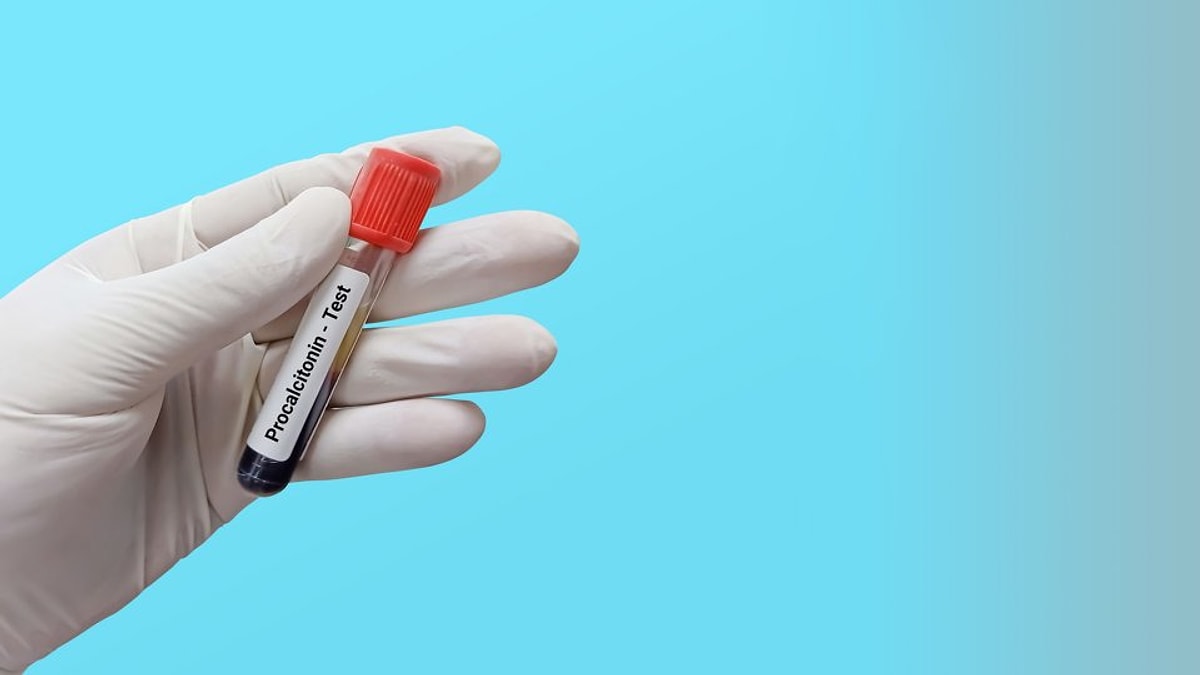 116 Aminoasitten Oluşan Bir Protein Olarak Bilinen PCT (Prokalsitonin ...