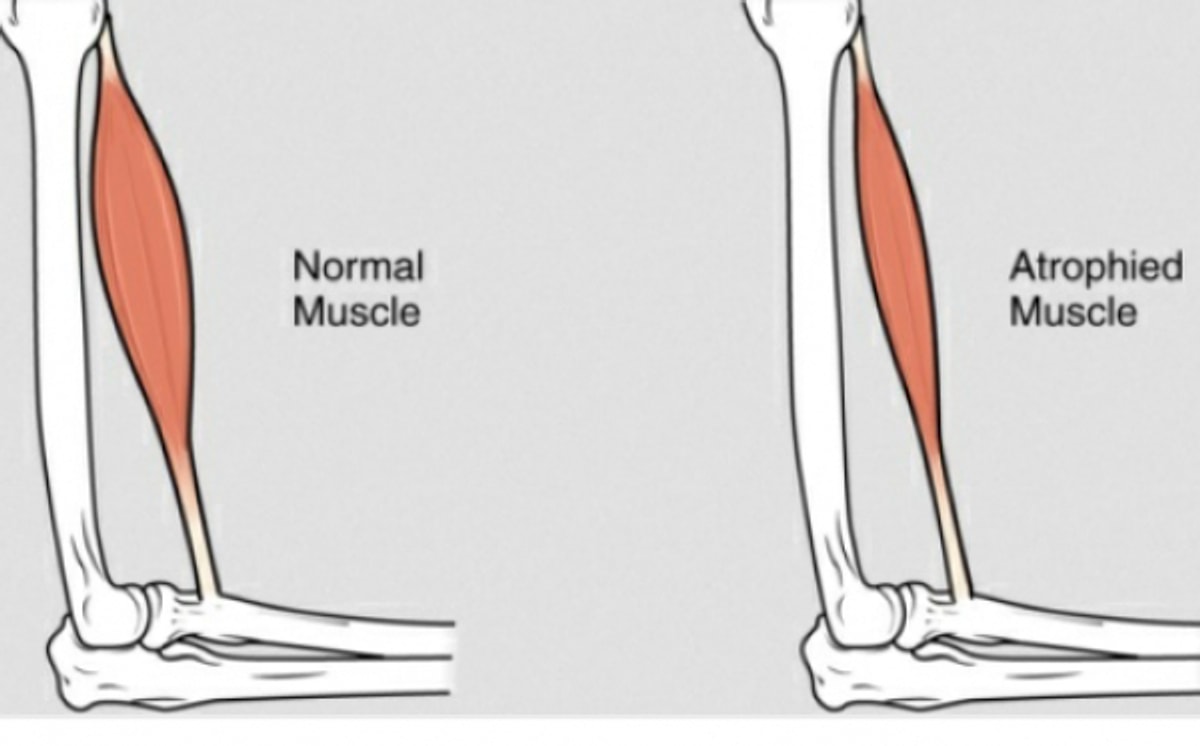 Atrofi Nedir? - Onedio