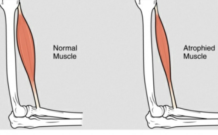 Atrofi Nedir? - Onedio