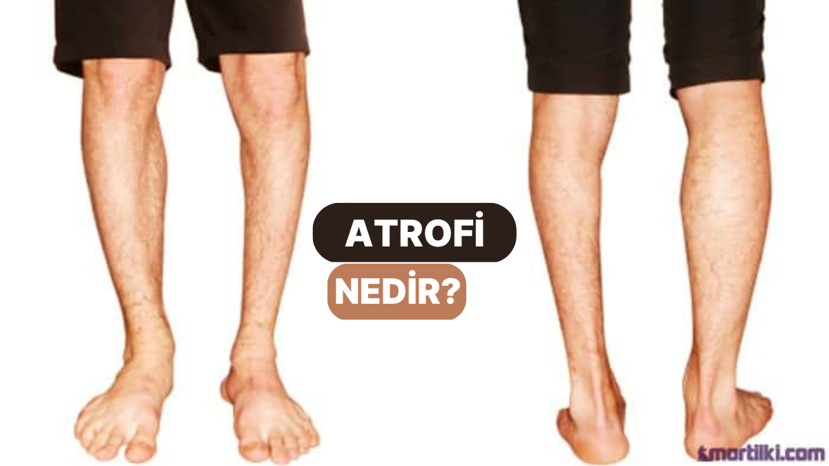 Atrofi Nedir? - Onedio
