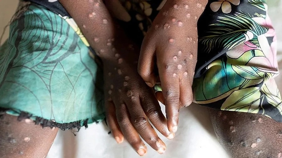 Danla Bilic Uyardı: Maymun Çiçeği Virüsünü Aylar Önce Bilen Yusuf Güney ...