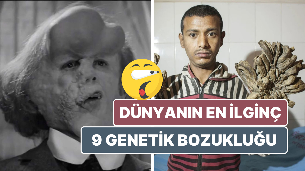 Vampir Hastalığı'ndan Fil Adam Sendromu'na: Dünyanın En İlginç 9 ...